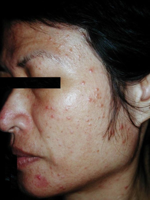 GRANULOMATOUS ROSACEA – Miracle Homeo Clinic